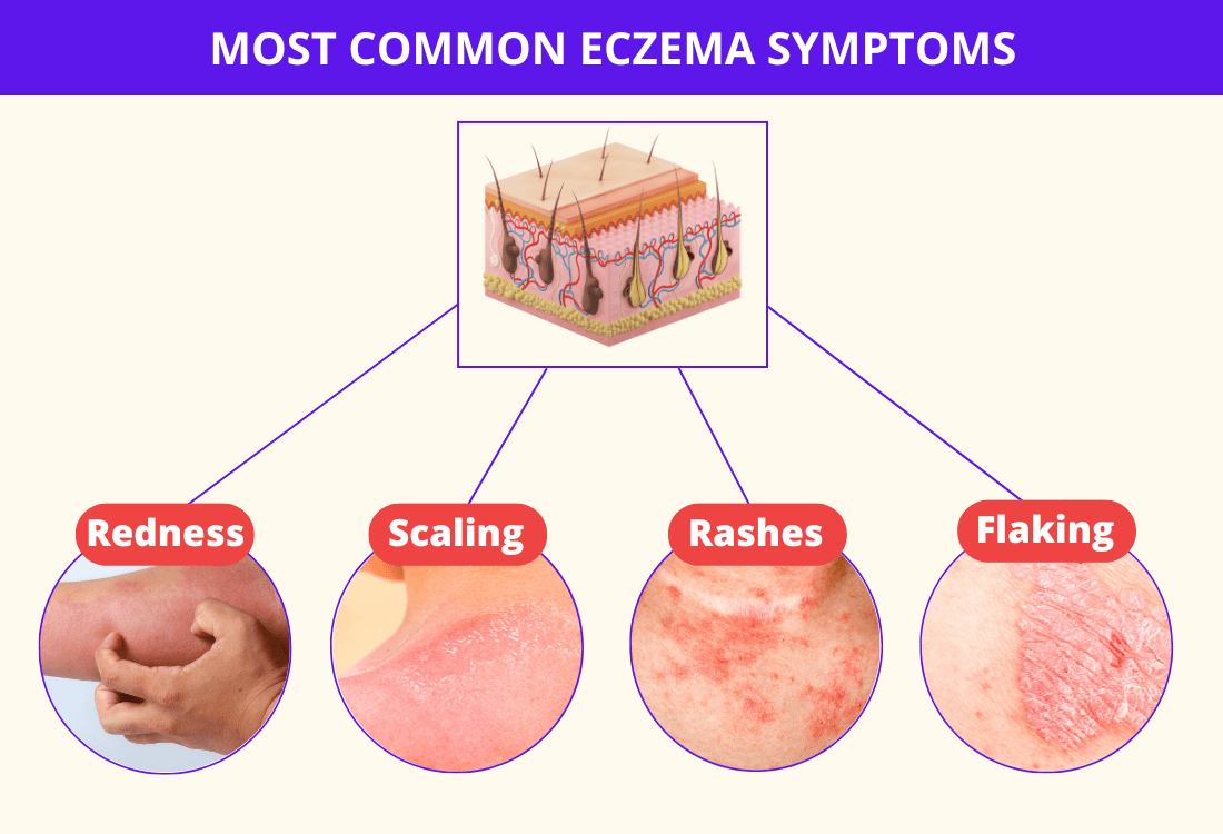 Break Your Eczema Cycle